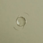 Refractive Lens Surgery Boston Massachusetts